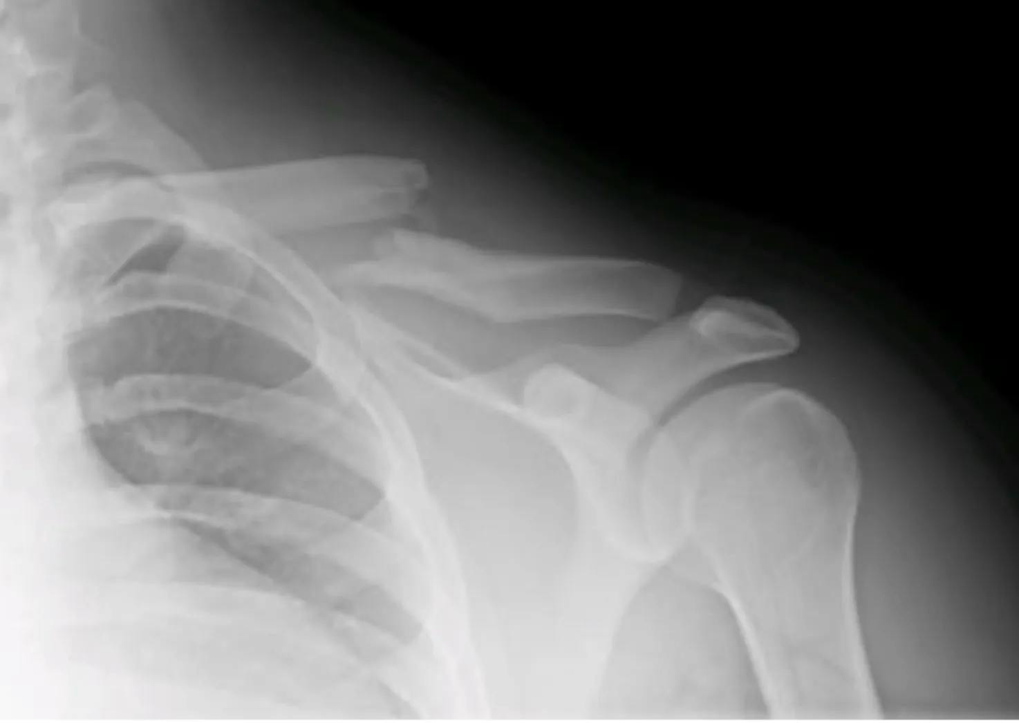Clavicle Fracture