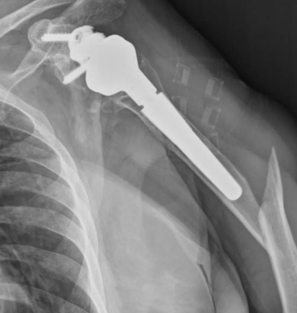 Periprosthetic Humerus Fracture